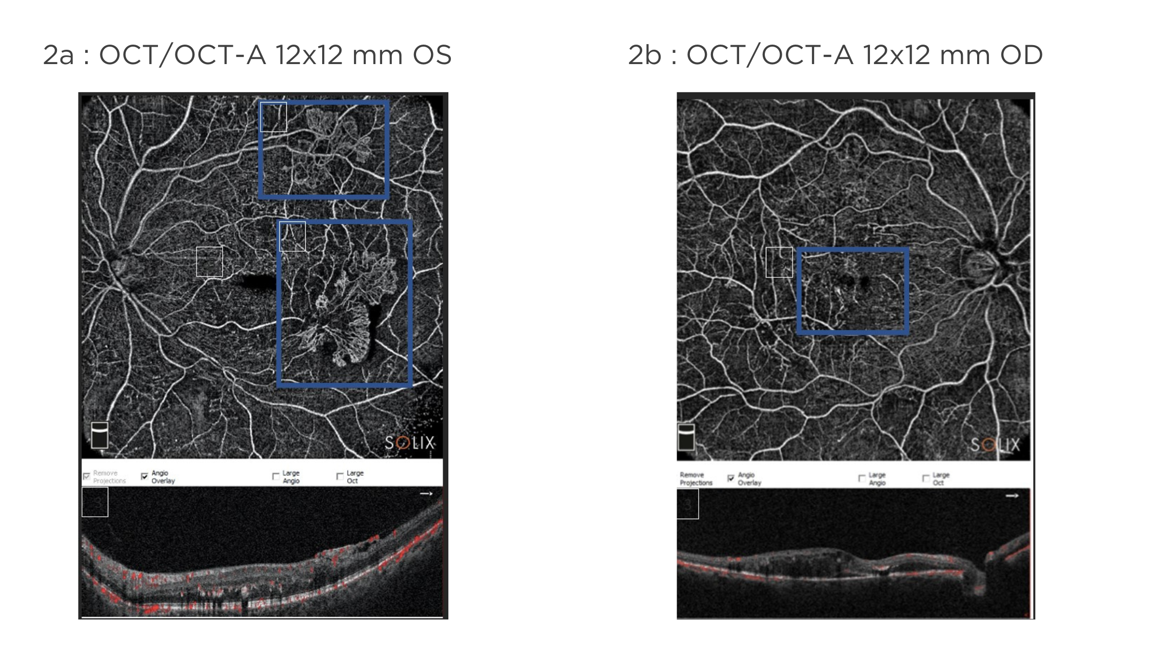 [ OCT ] Optovue Solix | Protocole Rétine